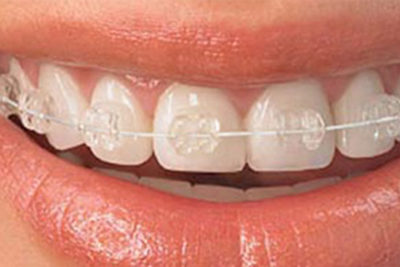 Quick Straight Teeth™ | Queensway Dental Practice